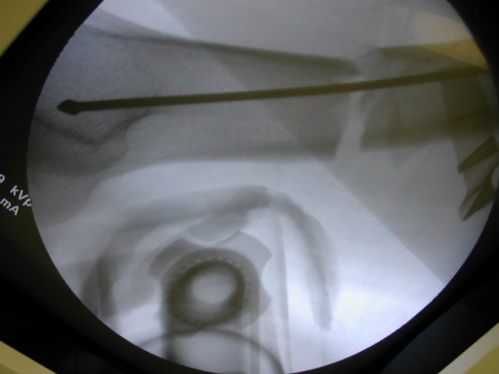 Femur Holder Lifter by Ed McMullin at Coroflot.com