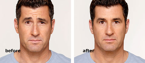 Botox before and after by Kathy Winston at Coroflot.com