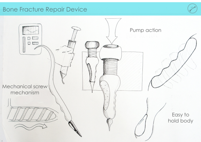 Bone Fracture Repair Device by Michael Heffernan at Coroflot.com