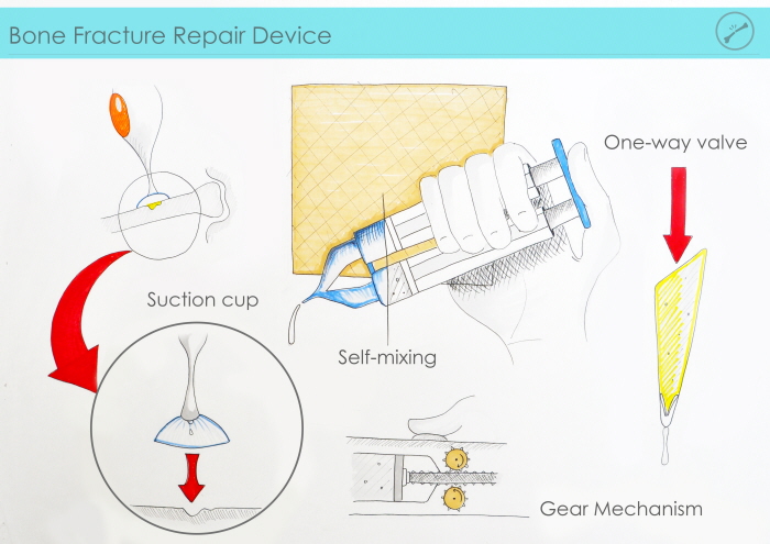 Bone Fracture Repair Device by Michael Heffernan at Coroflot.com