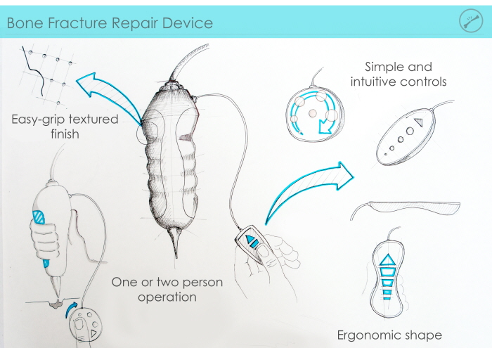 Bone Fracture Repair Device by Michael Heffernan at Coroflot.com