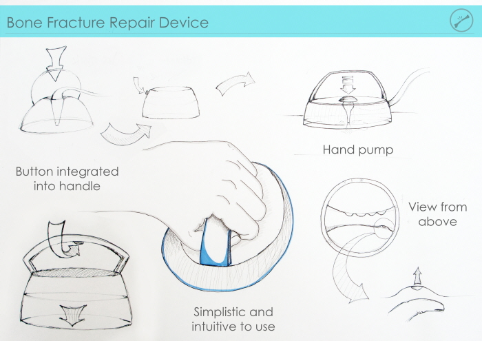 Bone Fracture Repair Device by Michael Heffernan at Coroflot.com