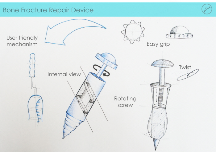 Bone Fracture Repair Device by Michael Heffernan at Coroflot.com