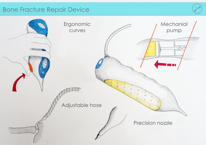 Bone Fracture Repair Device by Michael Heffernan at Coroflot.com
