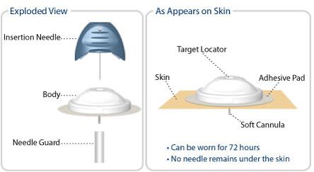 I-Port Diabetic Infusion Set (via Avail Medical) by Kraig Kooiman at ...