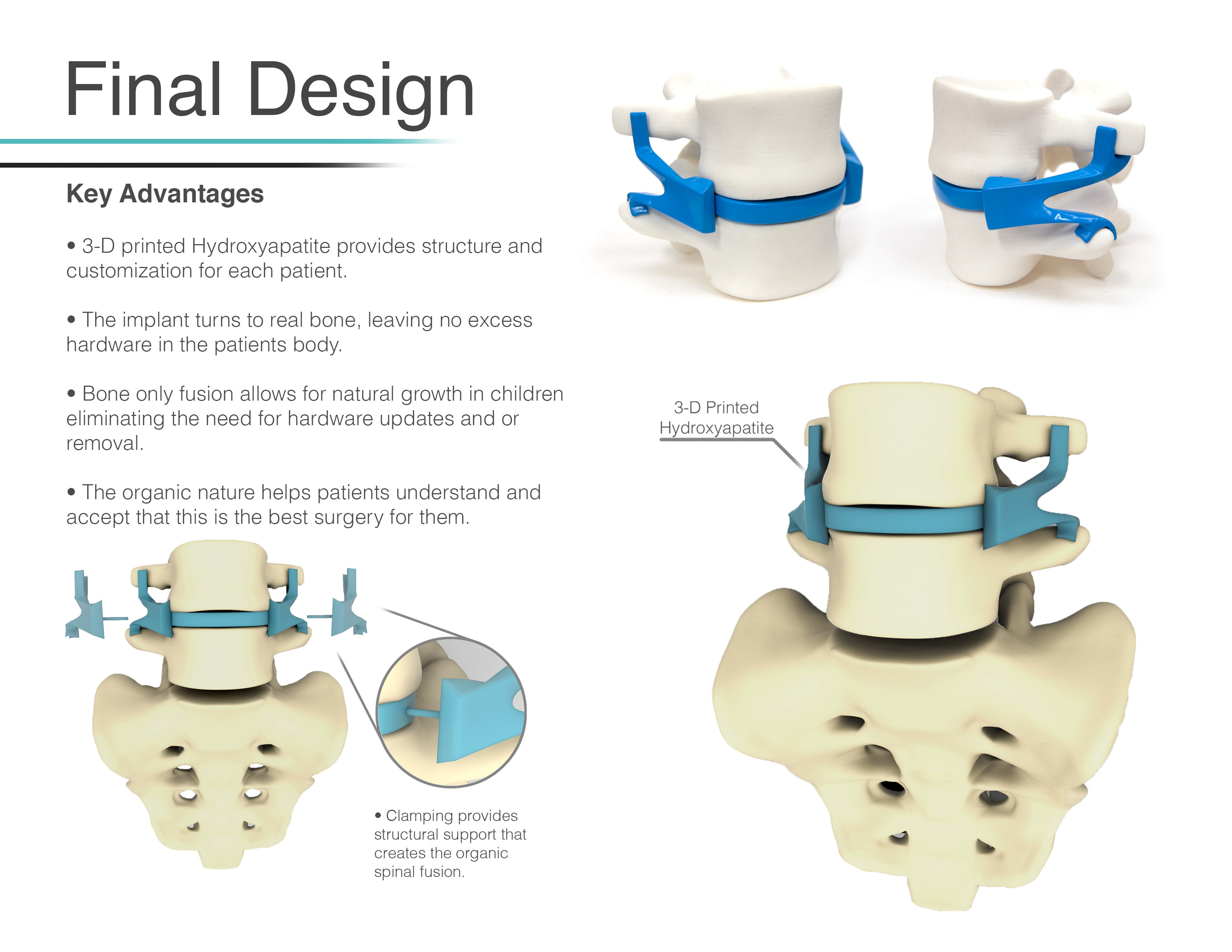 Lumbar Spinal Fusion Process by Nathan Warwick at Coroflot.com